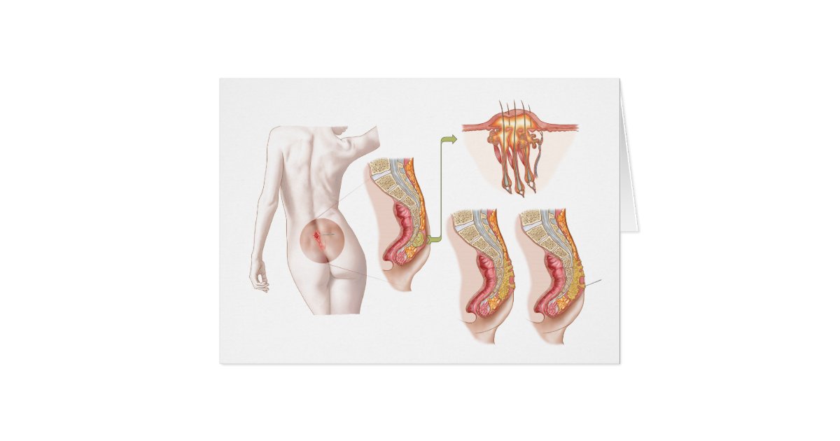 Medical Ilustration Of A Pilonidal Cyst Zazzle