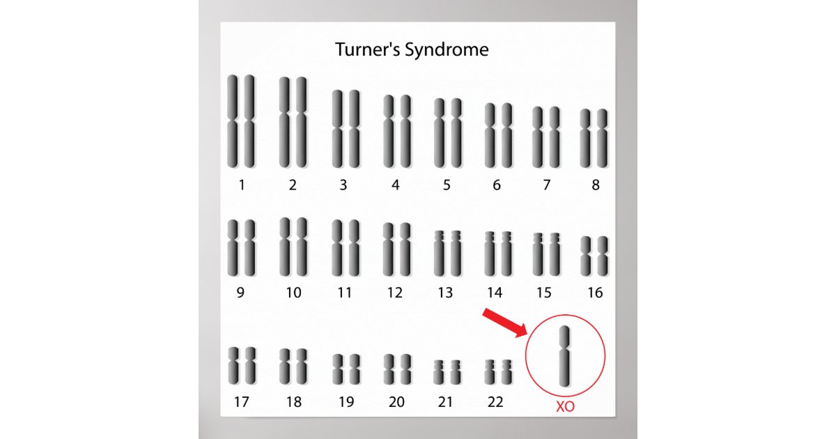 Monosomy X, Turner's syndrome Poster | Zazzle