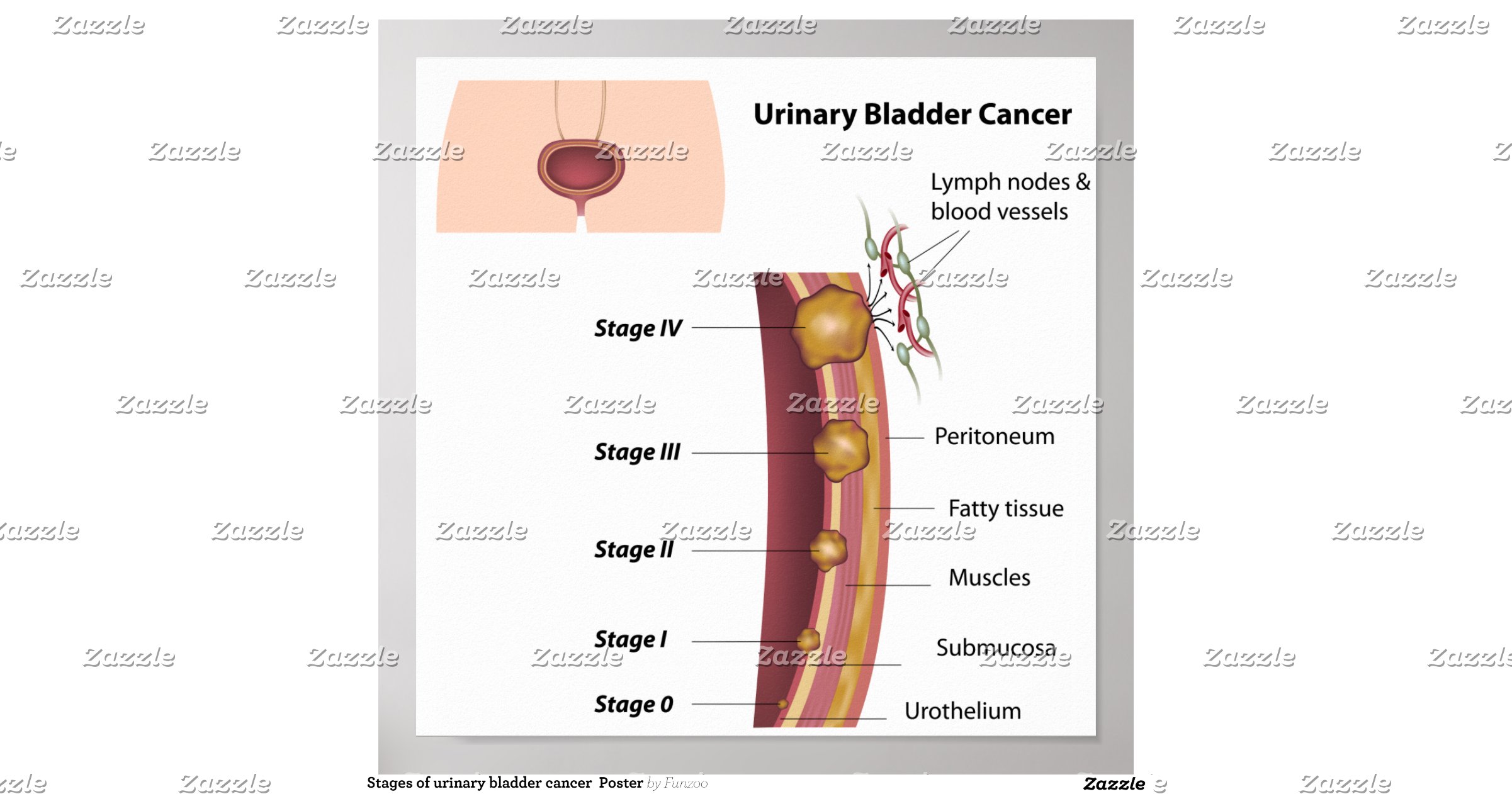 Stages of urinary bladder cancer Poster | Zazzle